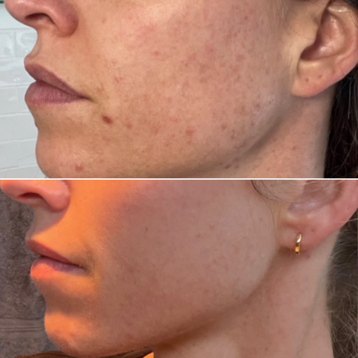 New Client | Skin Needling + Skin Consultation + LED – The Skin Bar