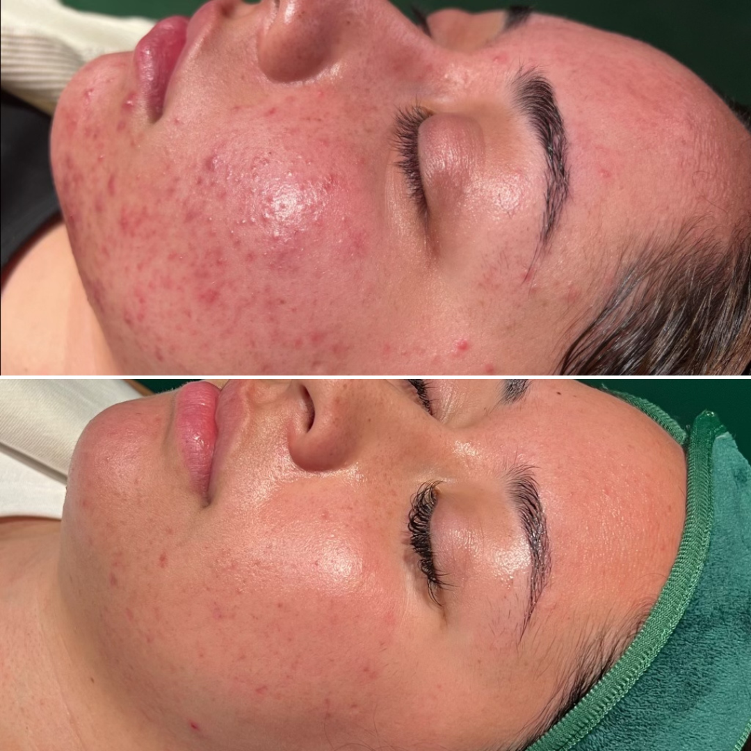 The Skin Bar - Australia's Skin Needling Experts