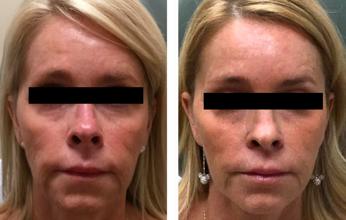Introductory Offer - RF Skin Needling - Face & Neck x 3 Pack – The Skin ...