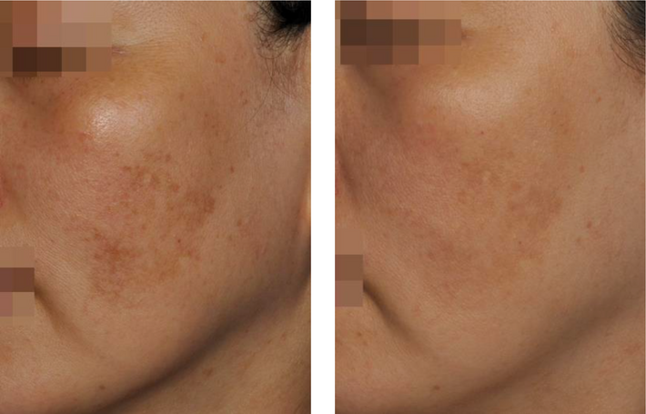 Introductory Offer - RF Skin Needling - Face & Neck x 3 Pack – The Skin ...